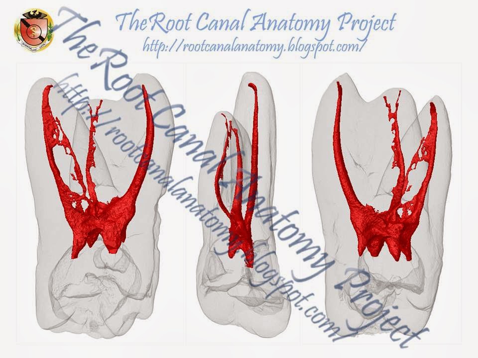 The Root Canal Anatomy Project: Maxillary First Molar: MB2