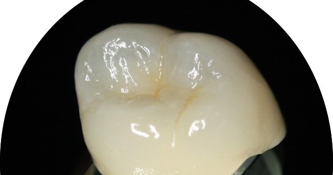 Odontology Student: Prosthodontics: The Metal-Ceramic Crown Preparation ...