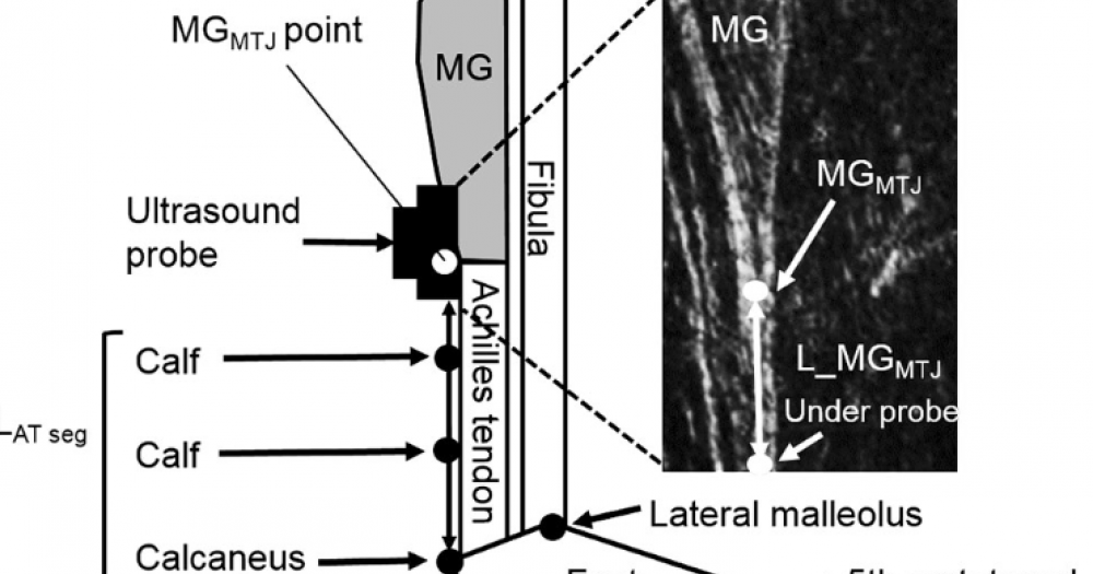 Neuromechanical Deficits 1-2 years After Achilles Tendon Repair ...
