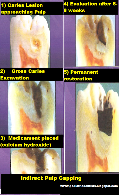 Dentistry and Medicine: Pulp therapy for primary teeth
