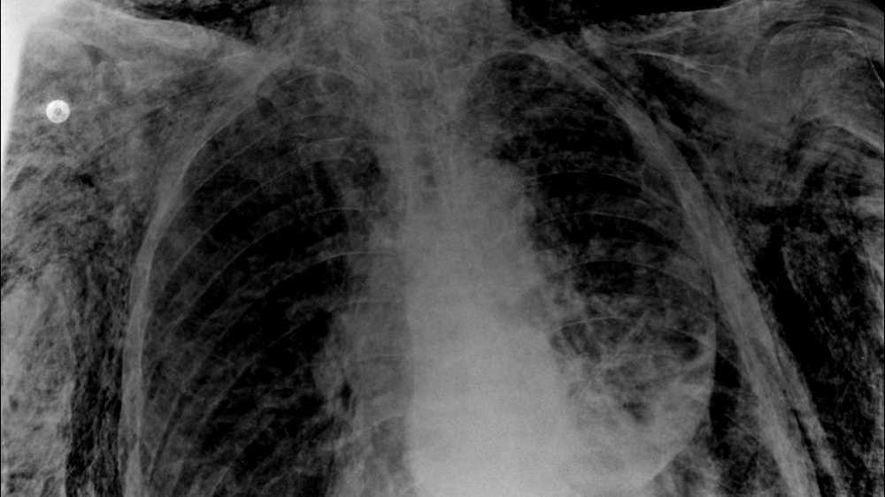 Subcutaneous emphysema
