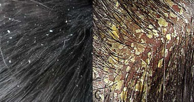 Estética Beleza e Saúde: Livre-se da caspa!