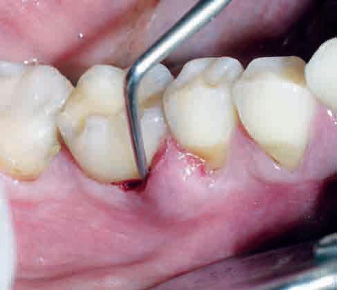 Absceso periodontal