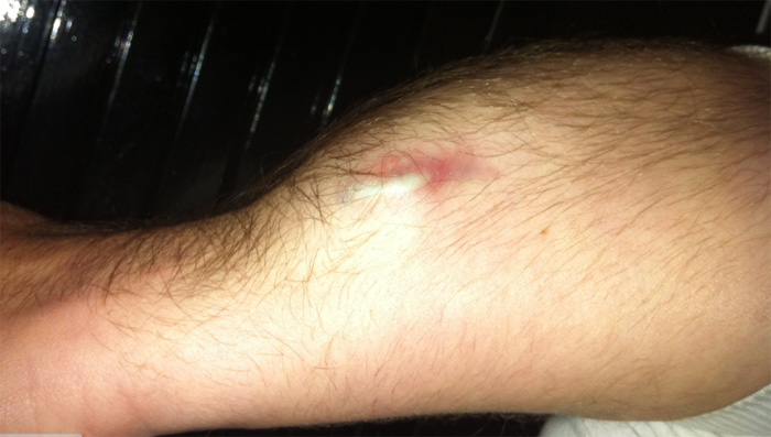 Phalloplastiek Nederland 2011 - 2019/ Phalloplasty experience blog ...