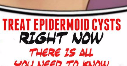 Epidermoid Cysts: How to treat them and what you should know about them ...