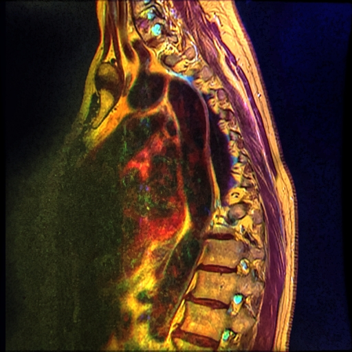 Nevit's blog: Dorsal Spine Color MRI