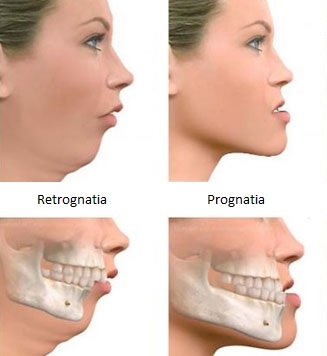 FISIO GARGON - Fisioterapia y Osteopatía: PATOLOGÍA DE LA ATM Y CÓMO ...