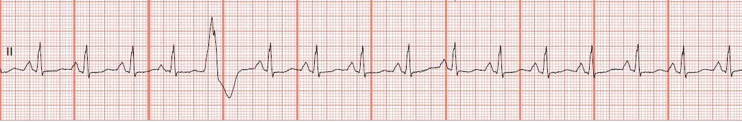 EKG Rhythm Strip Quiz 66