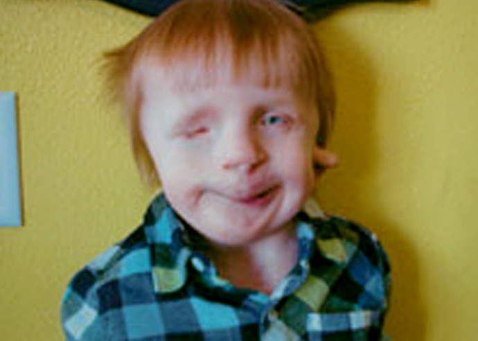 ChyntiaBlog: Kasus : Goldenhar syndrom (Oculo-Auriculo-Vertebral (OAV ...