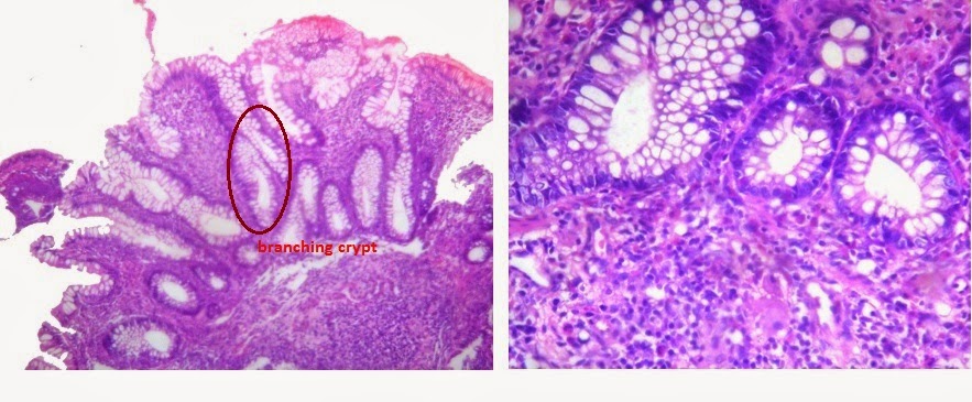 GASTROINTESTINAL AND LIVER HISTOLOGY PATHOLOGY ATLAS: COLON: ULCERATIVE ...