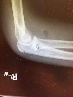 Shoulder and Elbow Surgery: "A Bullet in the radial head"