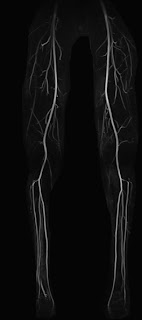My Radiology World: Non-contrast MRA of ArterIes and Veins
