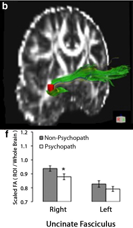 The psychopath brain | Psychopath Awareness