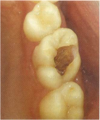 SMILE CARE: CLASSIFICATION OF DENTAL CARIES