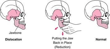 INCYDENTAL: Apollonius of Kition and the dislocated jaw