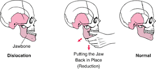 INCYDENTAL: Apollonius of Kition and the dislocated jaw