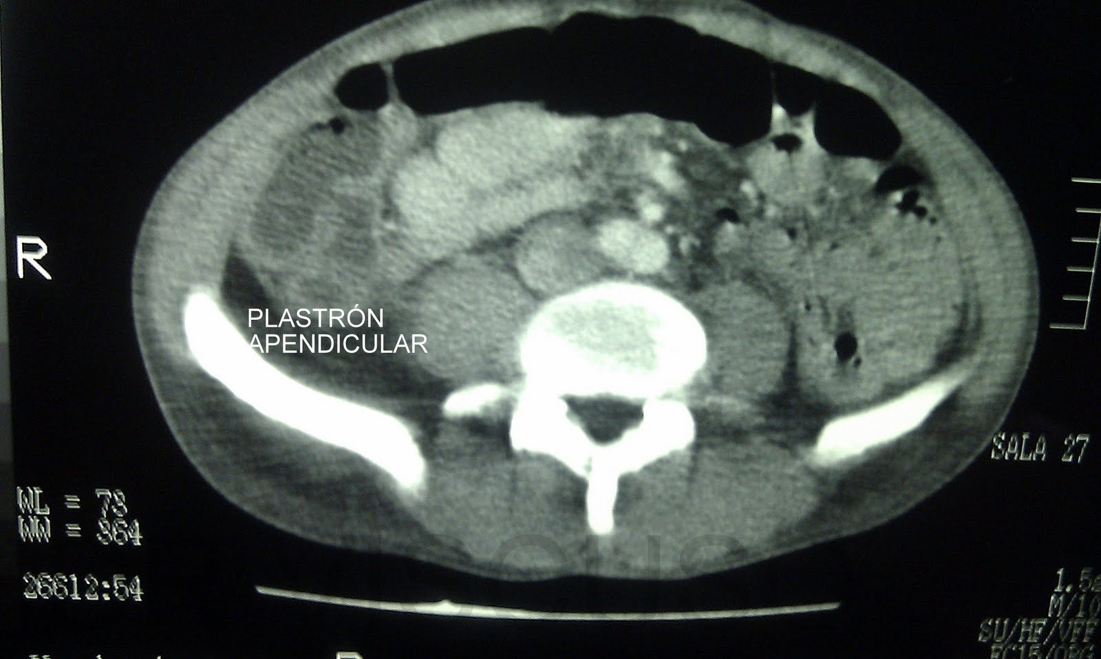 Que vi hoy: Absceso hepático post-apendicitis