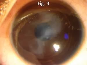 Eye Case of the Week: A Strange Growth 'in' the Cornea