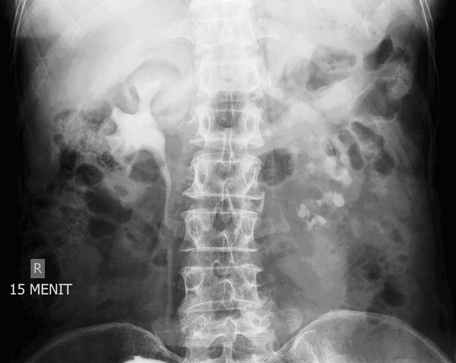 Dasar-Dasar Radiologi : Foto BNO-IVP - Catatan Dokter