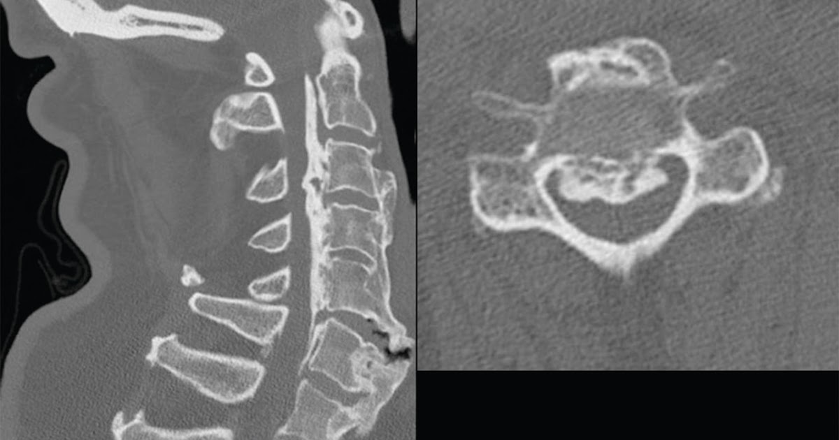 Ankylosing Spondylitis and Arthritis | Who Is Affected