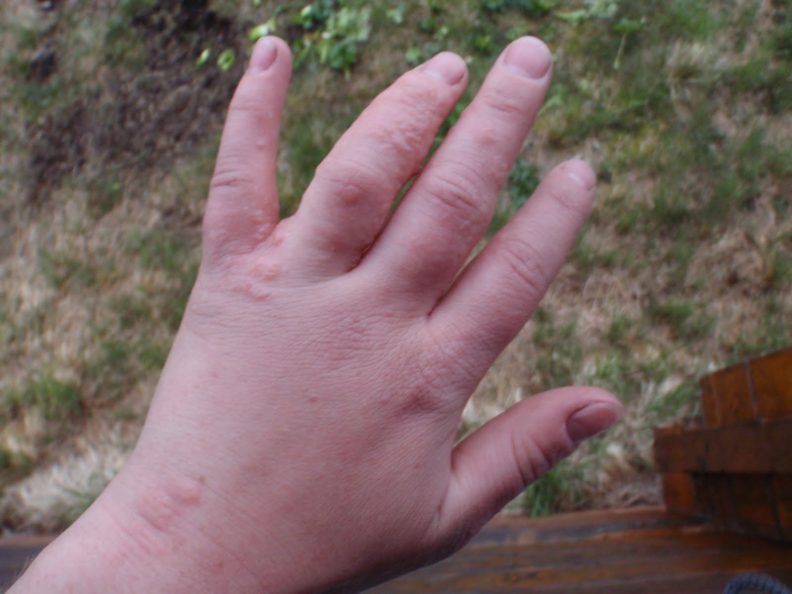 Fieldwork, Travel, and Food: Home early with bad pushki burns