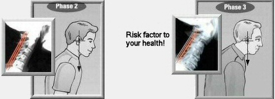 Magna Chiropractic Blog: Forward Head Posture