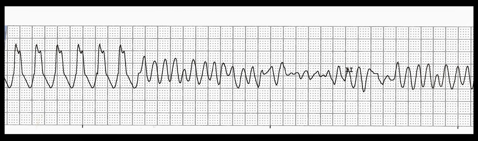 Various Ventricular Tachycardias