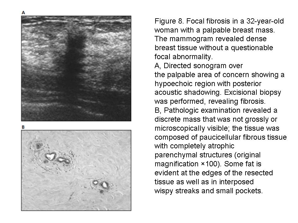 BÀI SOẠN VỀ SIÊU ÂM CHẨN ĐOÁN: Posterior Acoustic Shadowing in Benign ...