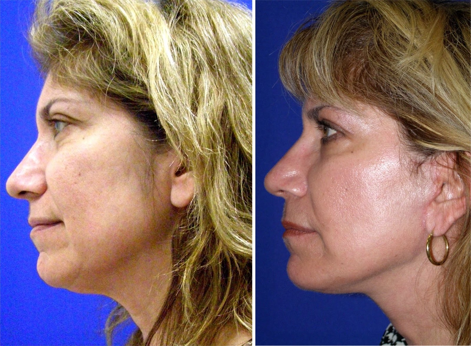Facelift Toning Workouts To Renew Your Neck And Face: Face Toning ...