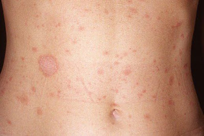 Pityriasis Rosea : A Strange Full Body Rash ~ Health Plus Art