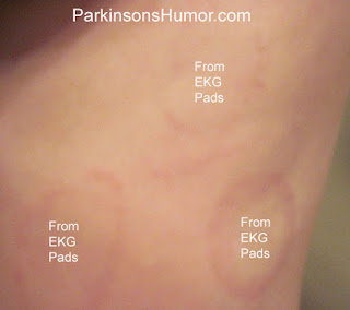 Parkinson's Humor: Parkinson's DBS Surgery: Part 3, the Generator Implant