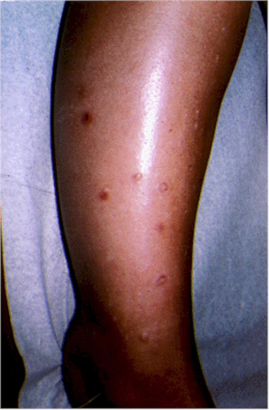 Complex Regional Pain Syndrome:This is MY life, doc!: SIGNS AND ...