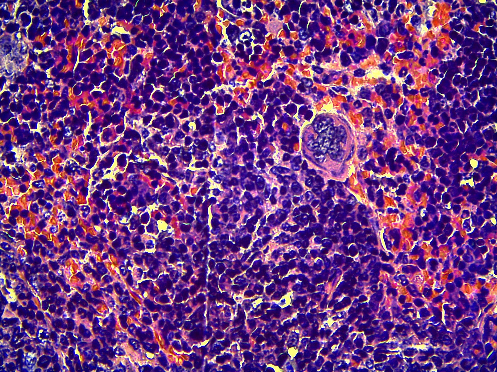 Hematopoyesis extramedular: bazo