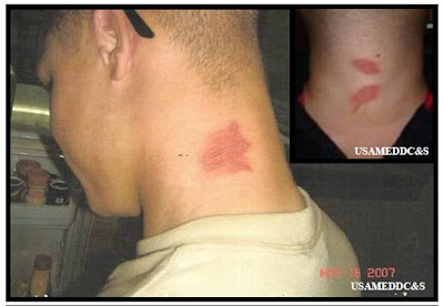 matarasakata: Tomcat menyebabkan Herpes?