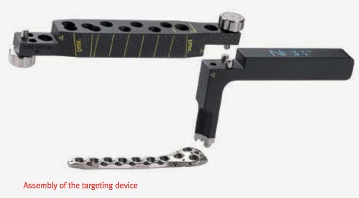 Chia-Wei Lin MD. | 林佳緯 醫師: 以微創手術（NCB-PH locking plate）治療近端肱骨骨折