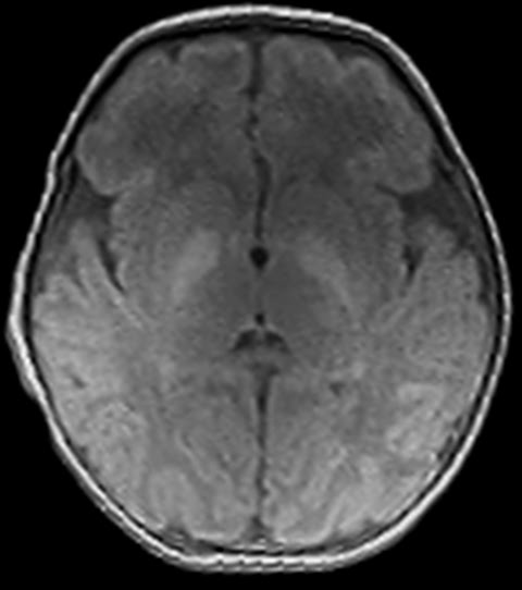 Kernicterus Mri