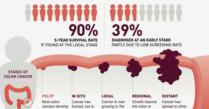 Health is Wealth: Little-Known Facts About Colon Cancer: Know Them ...