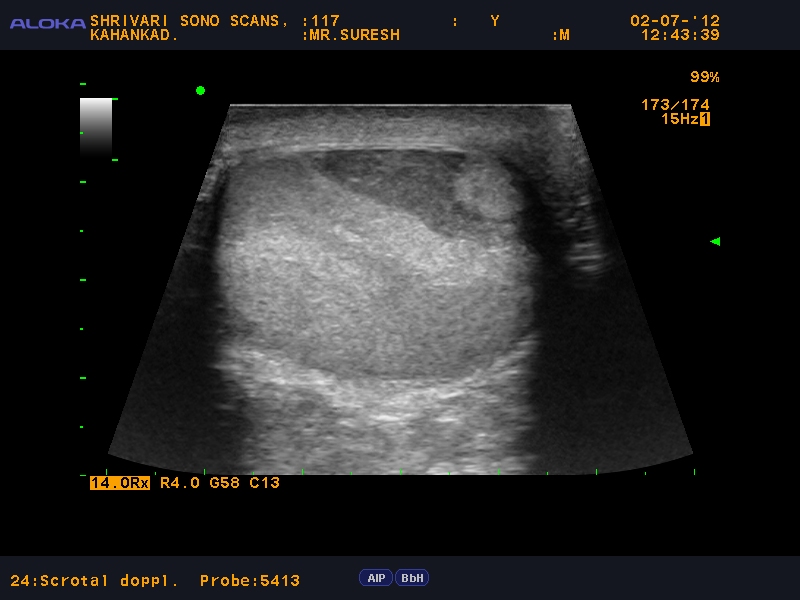 Shrivari Sono Scans: scrotal hrsg --reveals testicular fracture