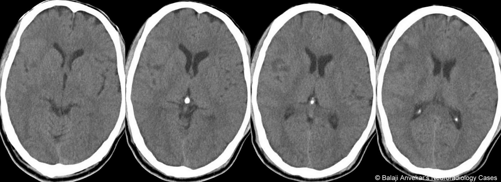 Dr Balaji Anvekar FRCR: Post TBM Vasculitis induced infarcts
