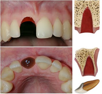 Tooth Avulsion; Dislocation, Tooth; Tooth Luxation; Avulsed Tooth