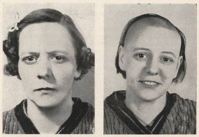 Do You Need a Lobotomy? Just Look at the Results From These Before and ...