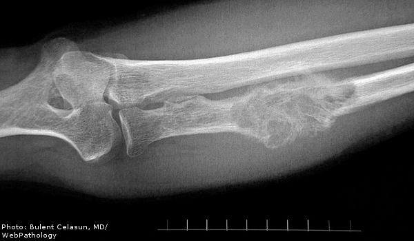 Knochenkrebs - Symptome und knochenkrebs arten. - Artikel über Gesundheit