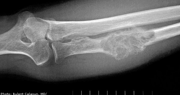 Knochenkrebs - Symptome und knochenkrebs arten. - Artikel über Gesundheit