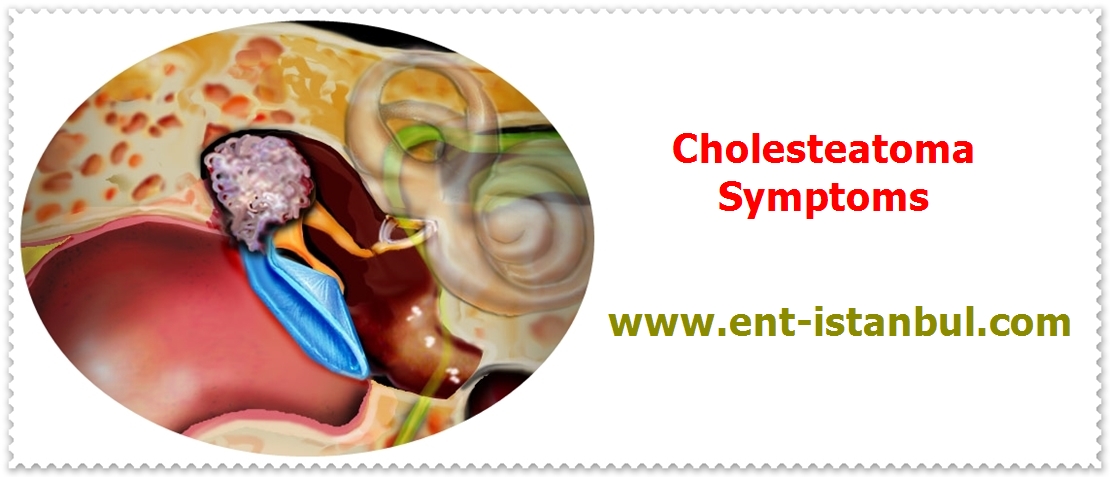 Cholesteatoma - Definition, Symptoms, Complications and Treatment