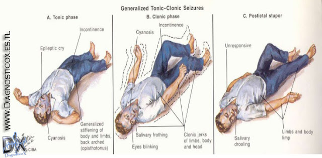 .: Manejo de las convulsiones: Estatus convulsivo [Temas de Guardia]