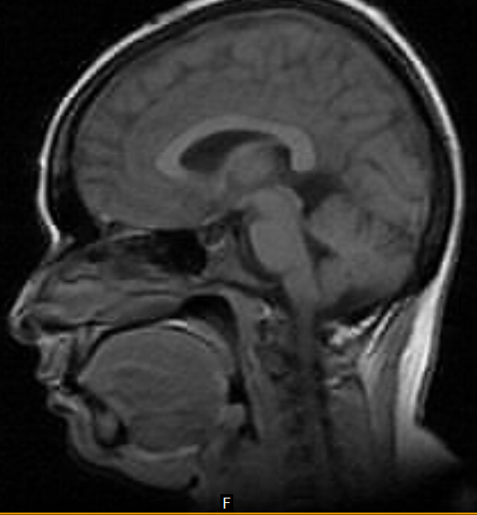 Idiopathic intracranial hypertension-MRI - Sumer's Radiology Blog