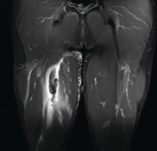 Treatment & Rehabilitation for Hamstring Avulsions