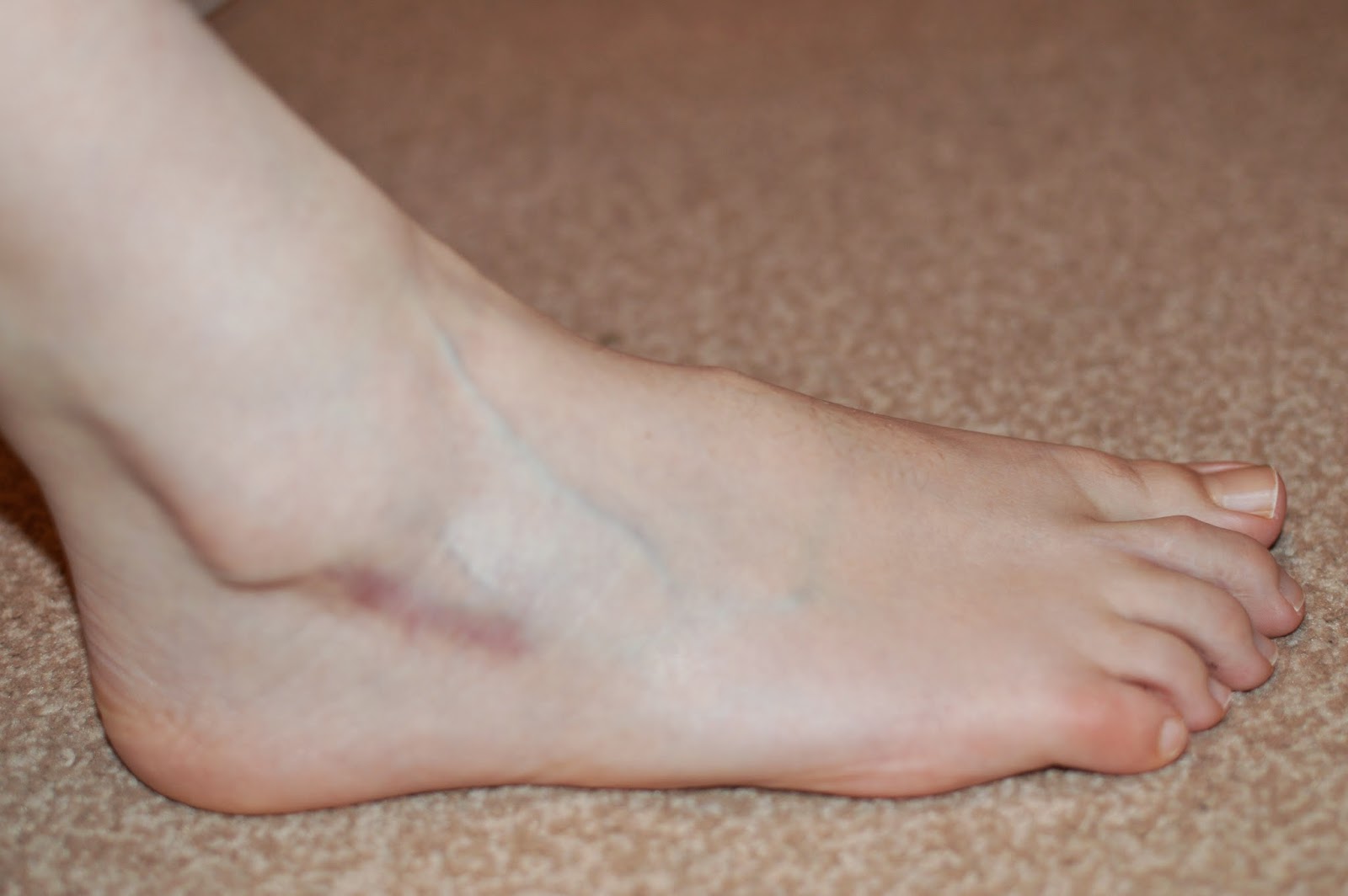 Syndactyly separation