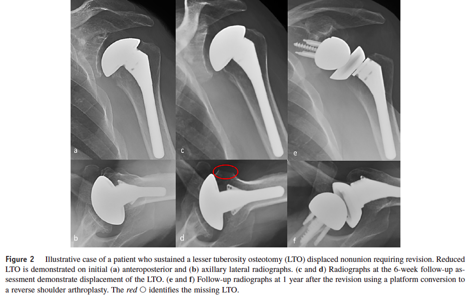 Shoulder Arthritis / Rotator Cuff Tears / Shoulder Pain : Is lesser ...