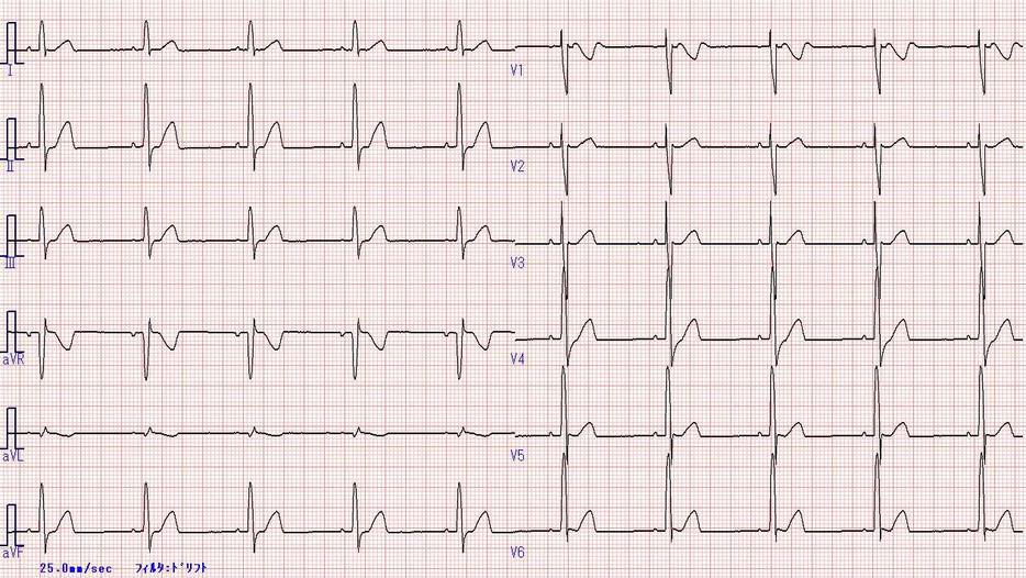 A school of fish swimming under thistles: Weird ECG